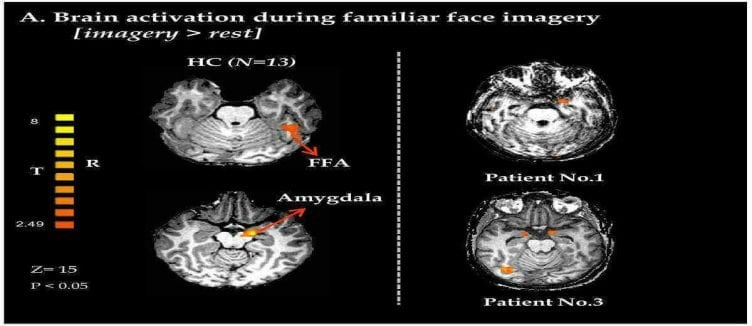 Do Patients in a Vegetative State Recognize Loved Ones? - Neuroscience News