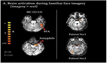 Do Patients in a Vegetative State Recognize Loved Ones? - Neuroscience News