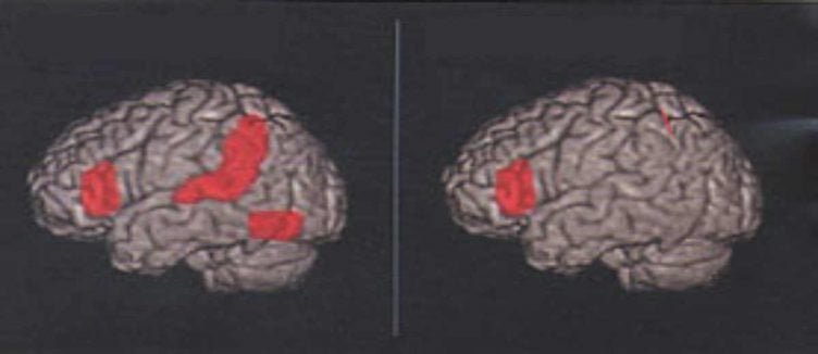 In Dyslexia, Less Brain Tissue Not to Blame for Reading Difficulties ...