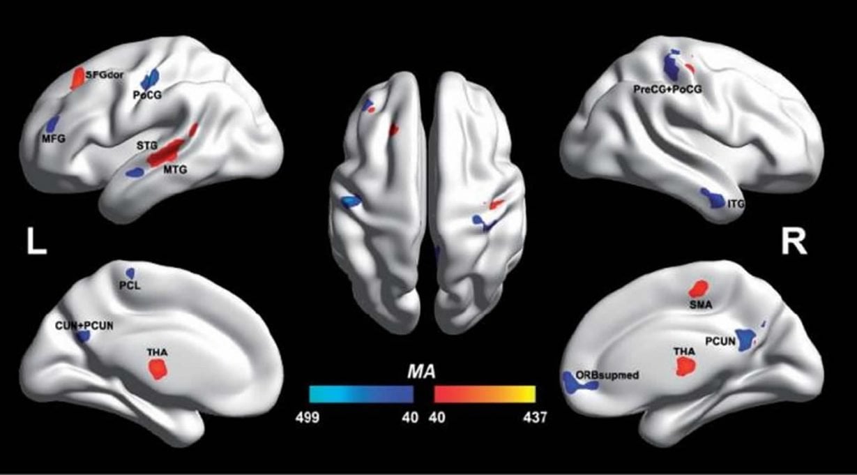 Autistic and Non-Autistic Brain Differences Isolated for First Time ...