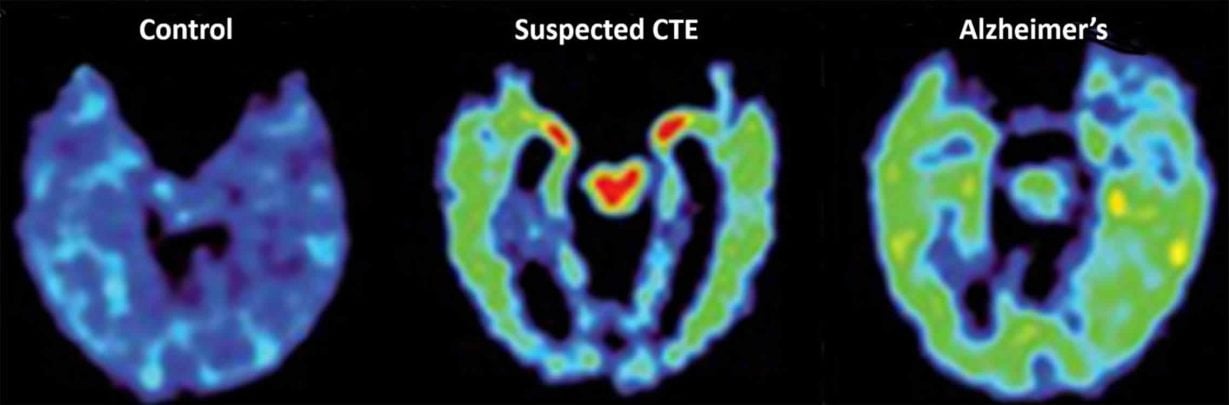 Abnormal Protein Patterns Seen in Brains of Retired NFL Players Who ...