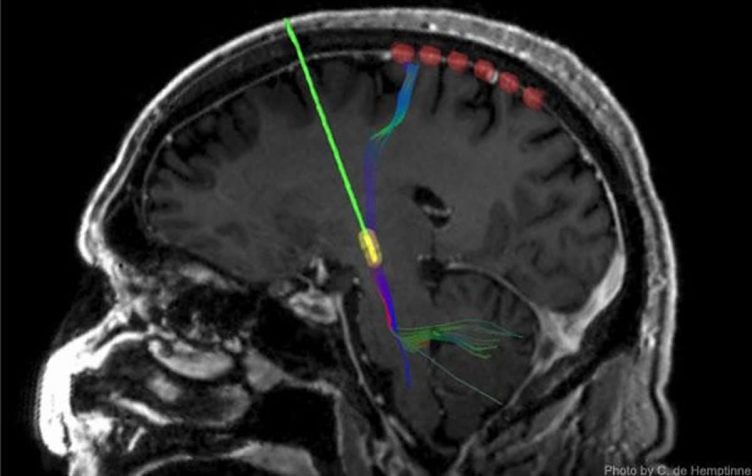 How Deep Brain Stimulation Exerts Therapeutic Effects for Parkinson's ...