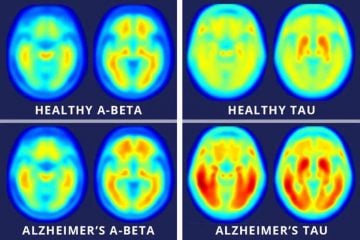 Tau Protein a Better Marker of Alzheimer's Progression Than Amyloid Beta - Neuroscience News