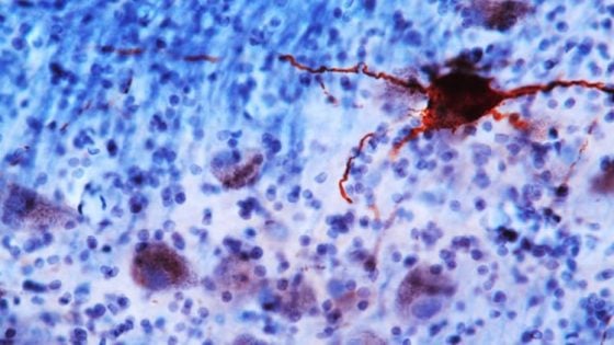 Early Alzheimer's Brain Pathology Linked to Psychiatric Symptoms ...