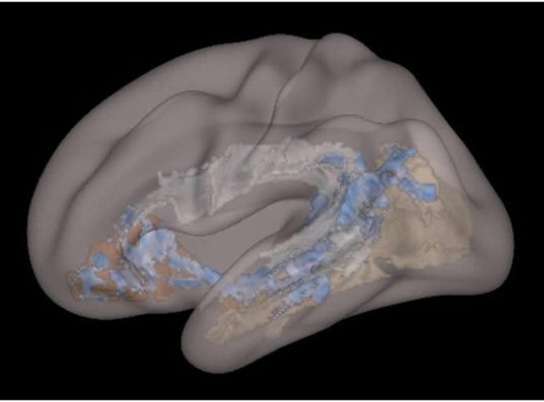 Screen-based media associated with structural differences in brains of ...