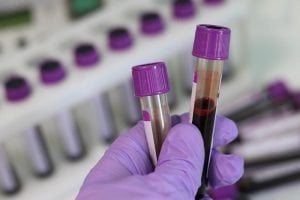 New blood test for Alzheimer's developed - Neuroscience News
