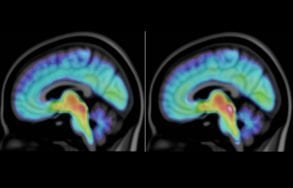 Imagery Reveals Autism-Related Brain Differences - Neuroscience News