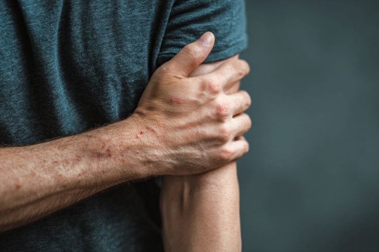 Touch Neurons That Drive Chronic Eczema Itch Revealed - Neuroscience News